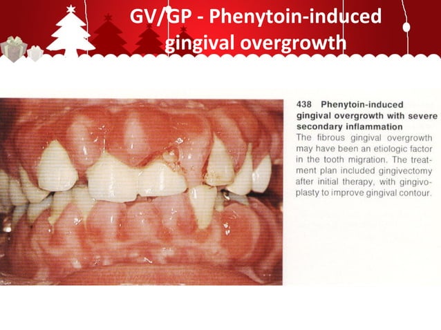 Gingivectomy | PPT | Oral care | Personal Care