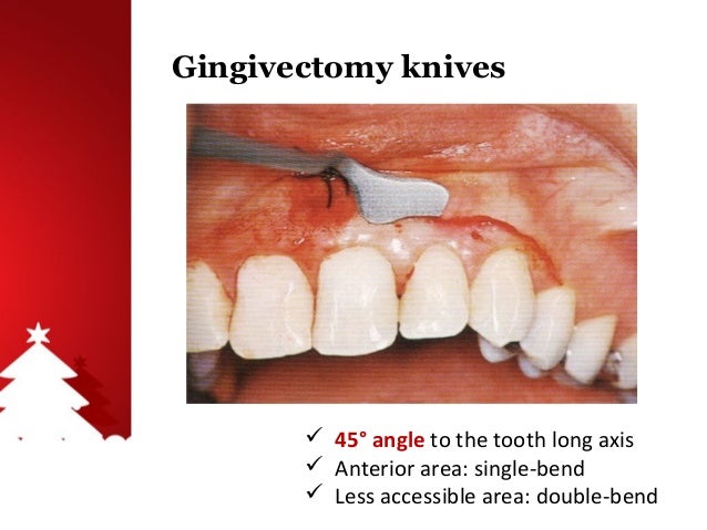 Gingivectomy