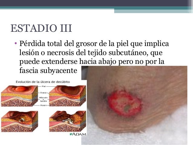 (2013-10-29) Manejo de las úlceras por presión (ppt)