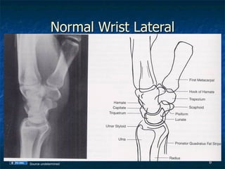 X Ray Wrist Lateral View