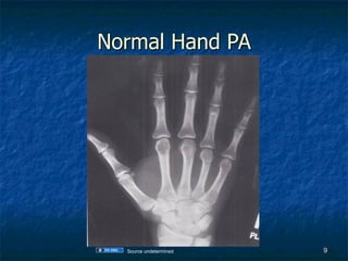 X Ray Hand Normal