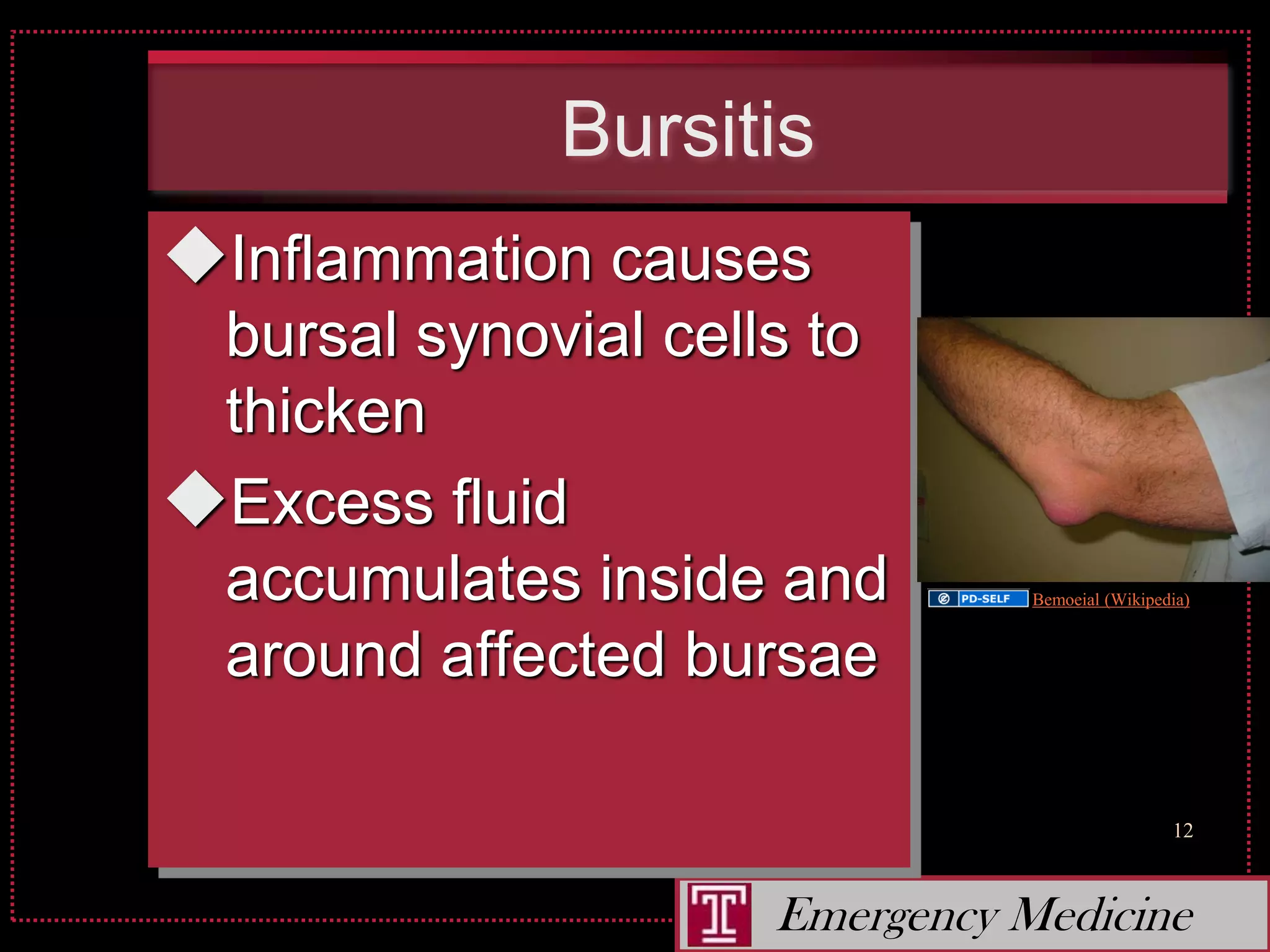 GEMC- Bursitis, Tendonitis, Fibromyalgia, and RSD- Resident Training | PDF