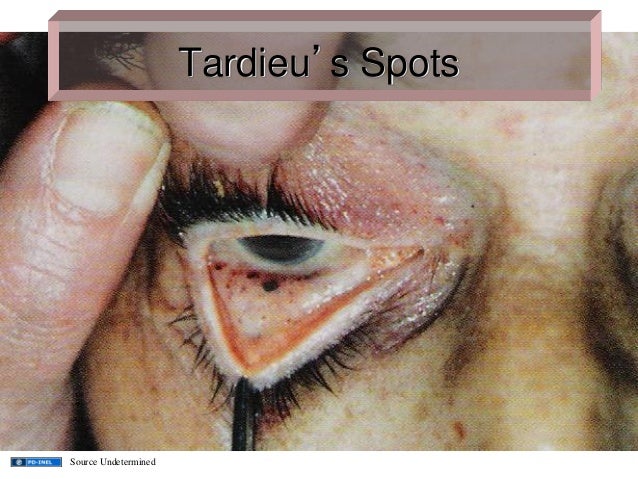 GEMC- Hanging and Strangulation, Asphyxiation & AeA "The Choking Game…