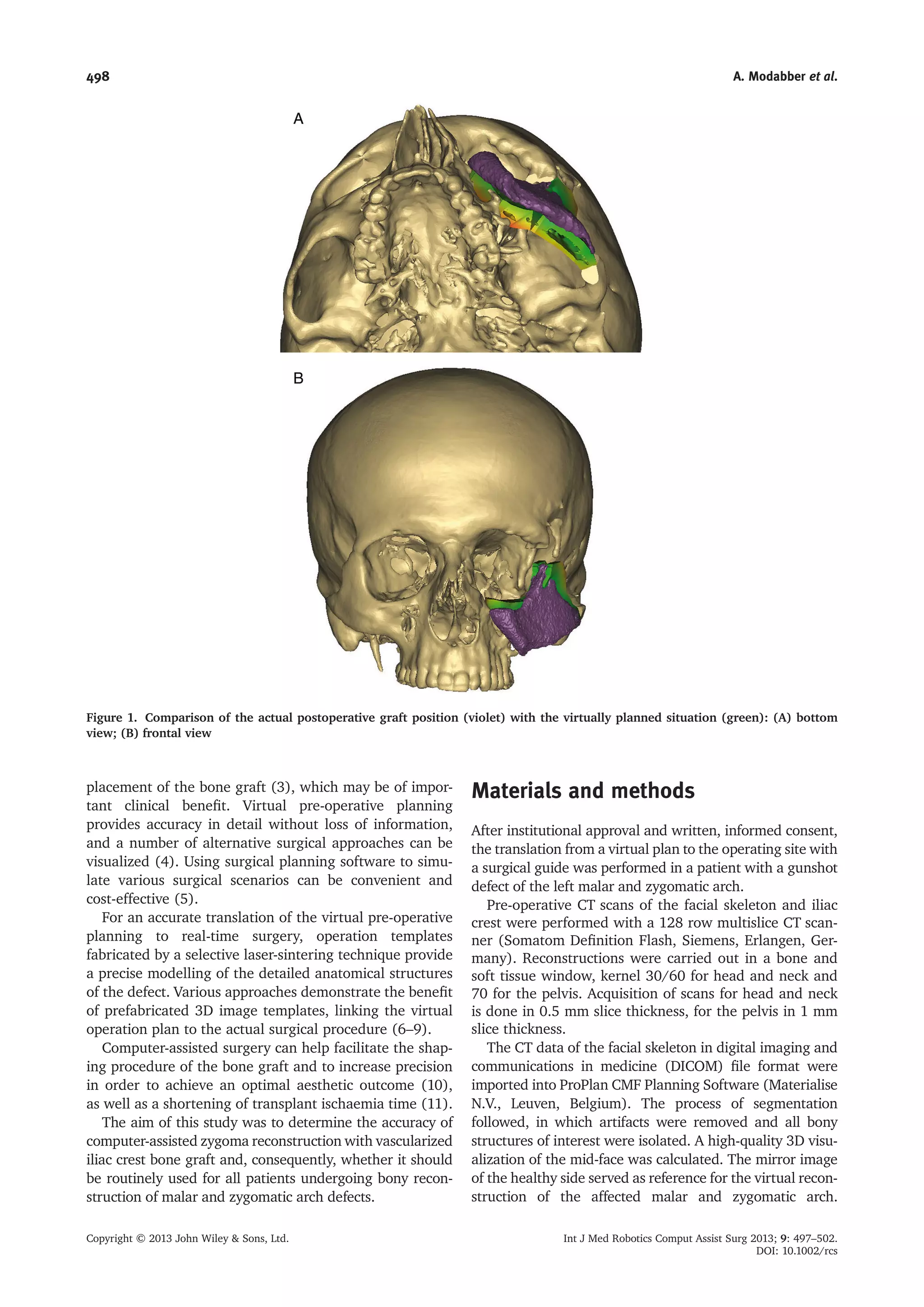 2013 modabber-zygoma-reconstruction | PDF