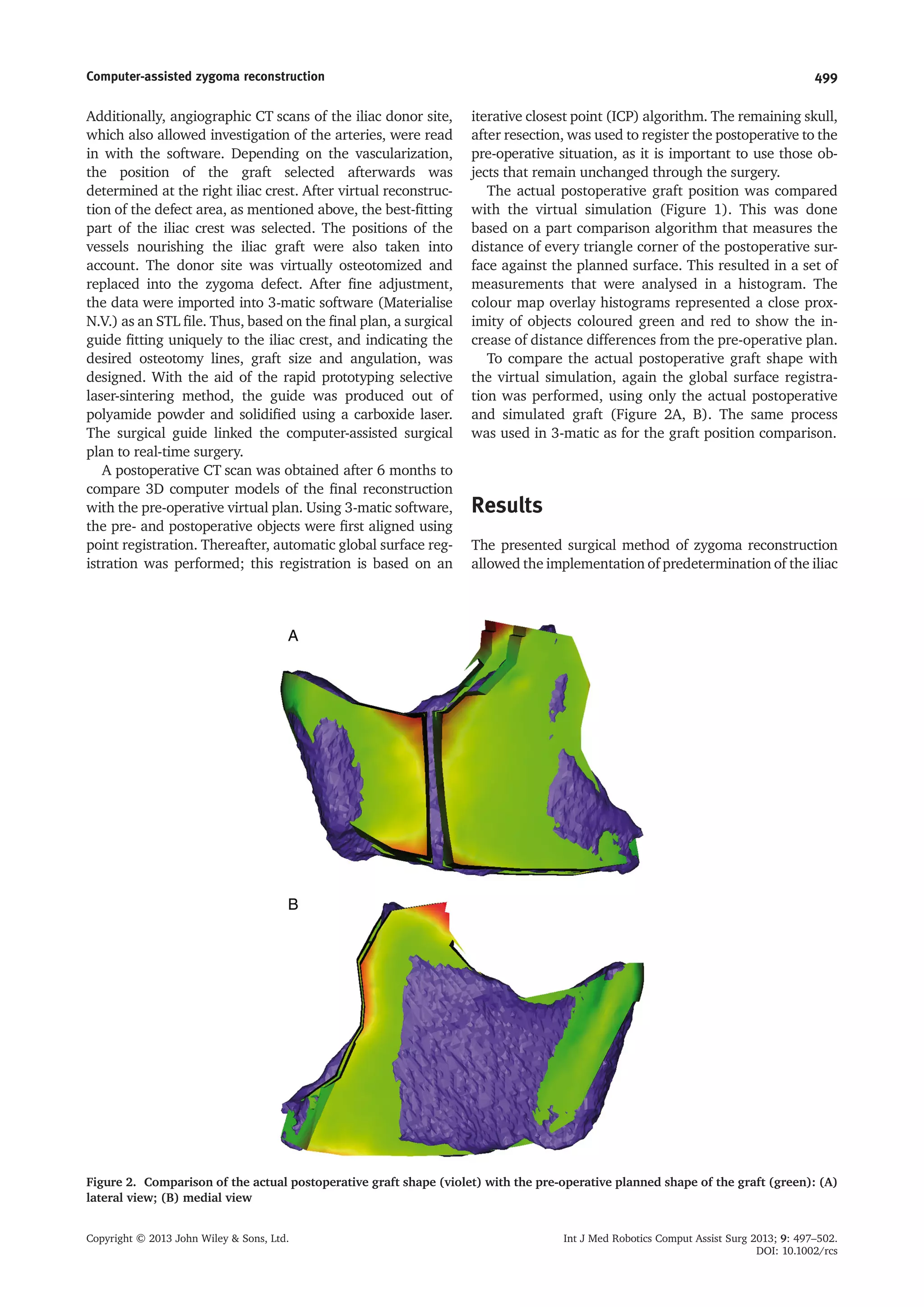 2013 modabber-zygoma-reconstruction | PDF
