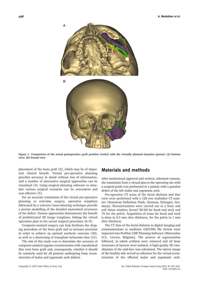 2013 modabber-zygoma-reconstruction | PDF