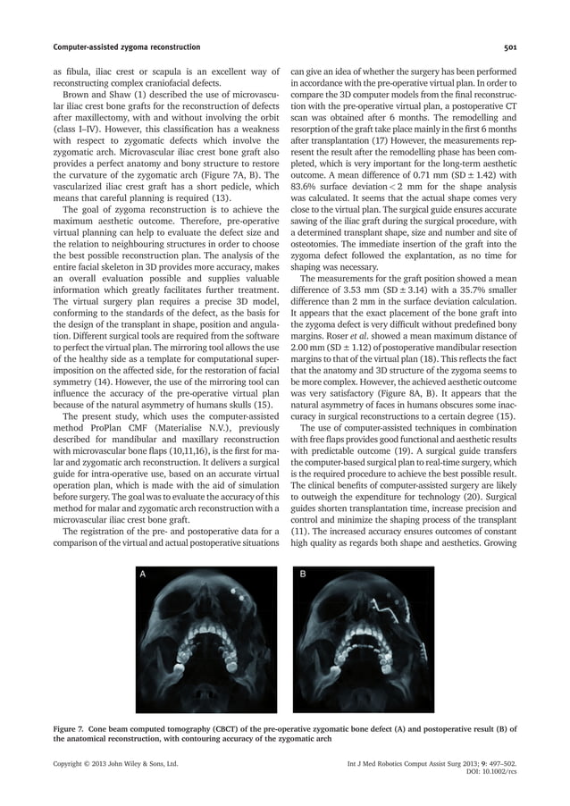 2013 modabber-zygoma-reconstruction | PDF