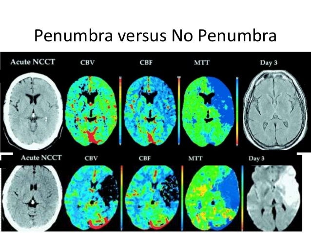 2013.stroke areyouready