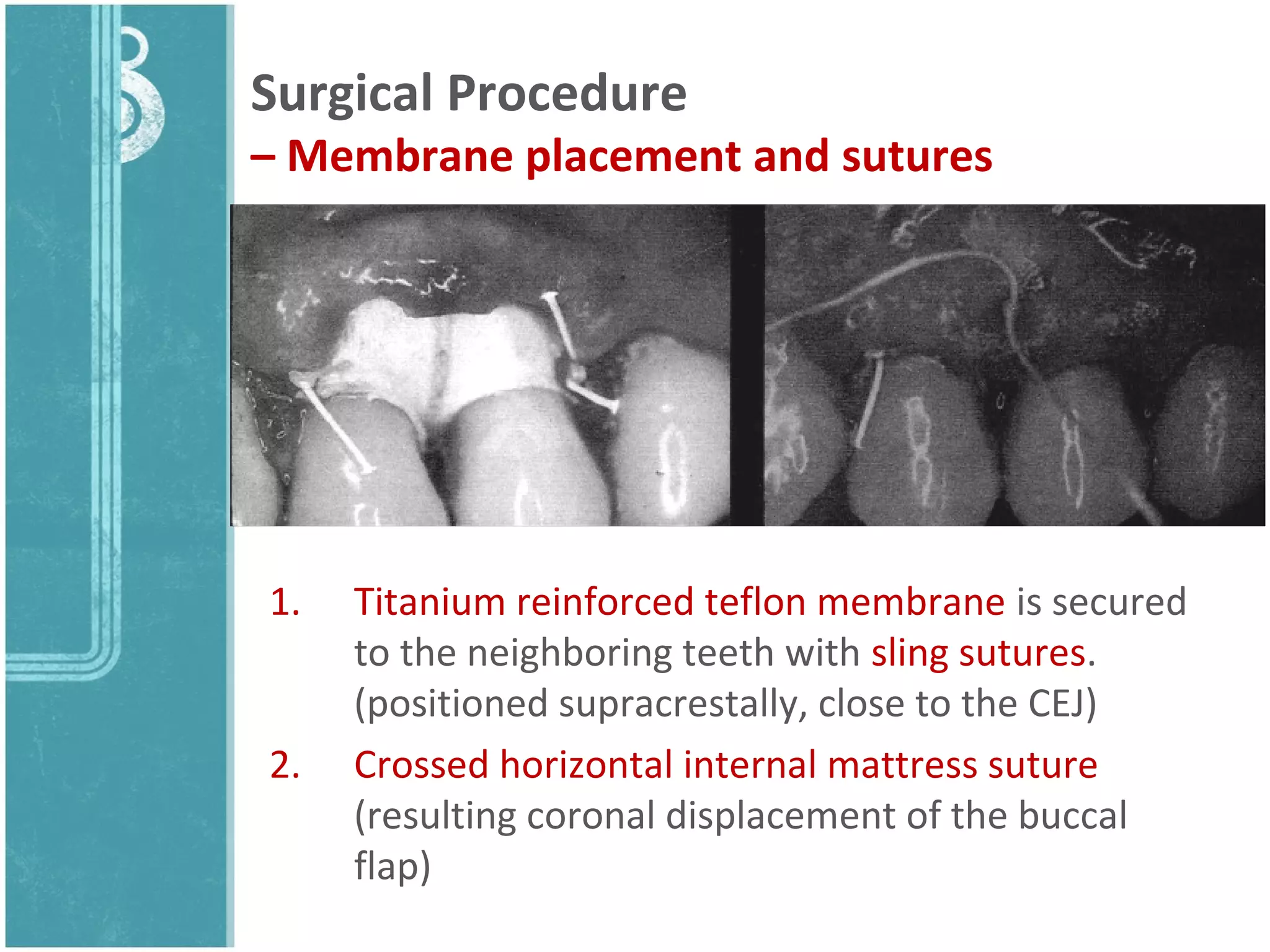 Modified Papilla Preservation Technique | PPT