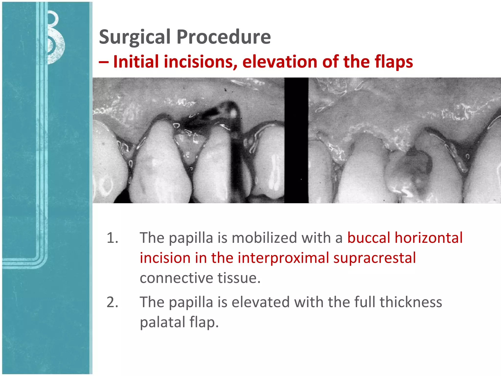 Modified Papilla Preservation Technique | PPT