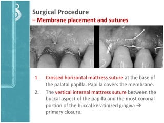 Modified Papilla Preservation Technique | PPT