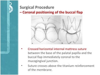 Modified Papilla Preservation Technique | PPT | Dental Health ...