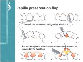 Modified Papilla Preservation Technique | PPT