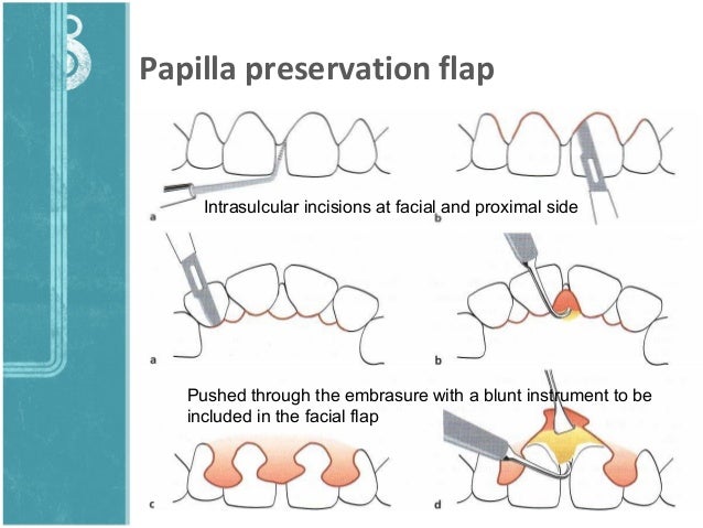 Modified Papilla Preservation Technique
