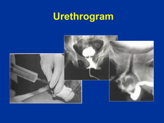 urethrography | PPT | Sexual Conditions | Sexual Health