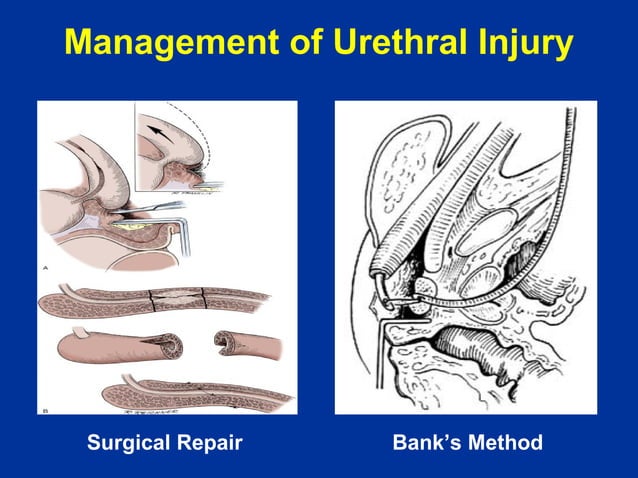 urethrography | PPT | Sexual Conditions | Sexual Health