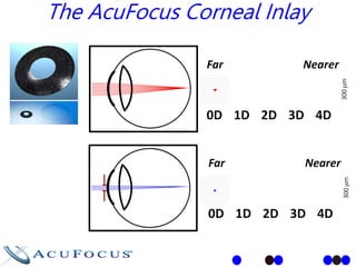 Why a pinhole? | PDF