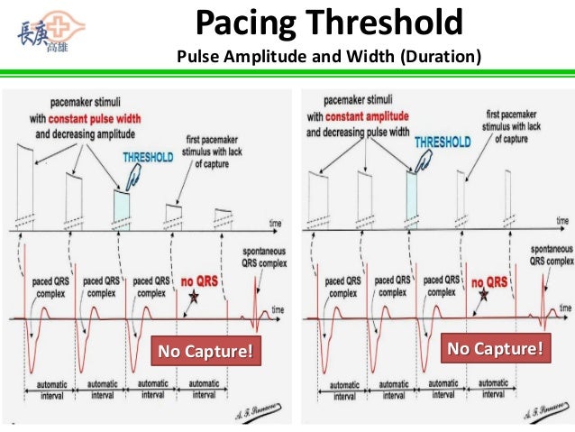 心臟植入性電子儀器(CIED)的基本原理及設定