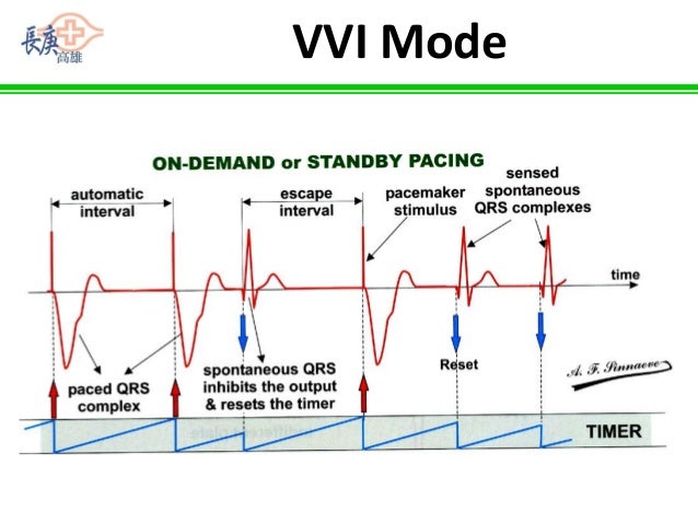 心臟植入性電子儀器(CIED)的基本原理及設定