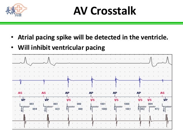 心臟植入性電子儀器(CIED)的基本原理及設定