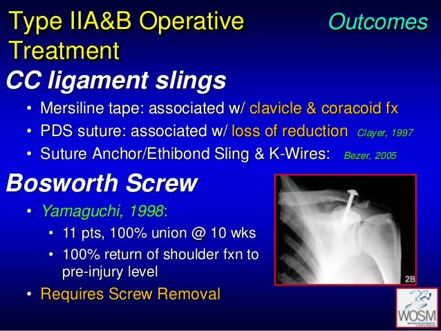 Distal Clavicle Fractures