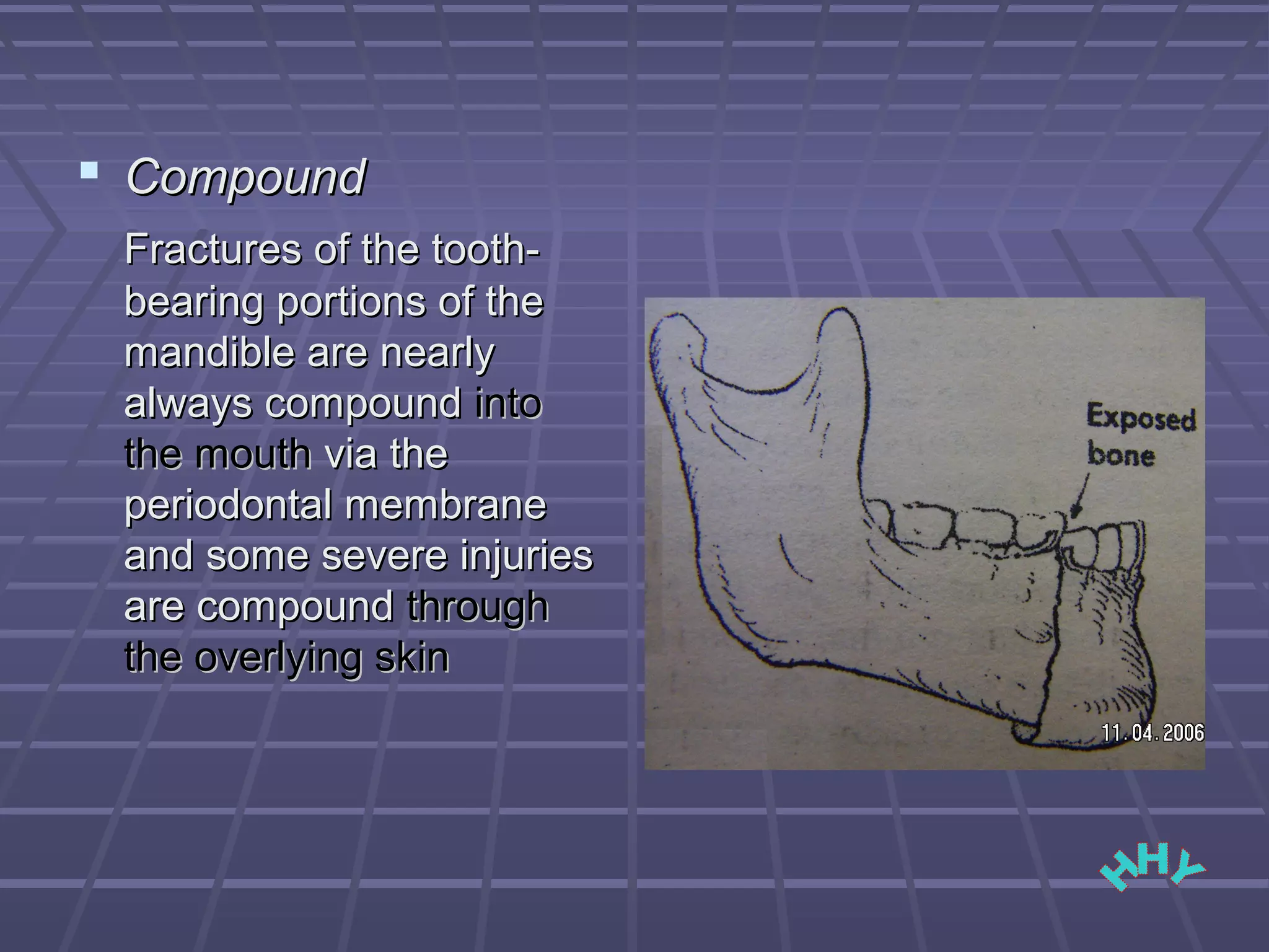 Fracture of the Mandible | PPT