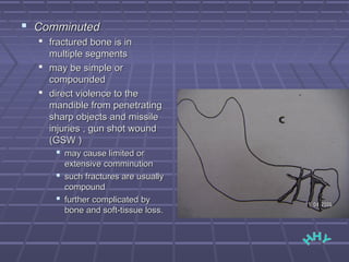 Fracture of the Mandible | PPT