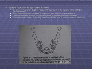 Bucket Handle Fracture