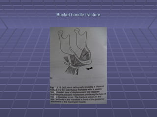Bucket Handle Fracture