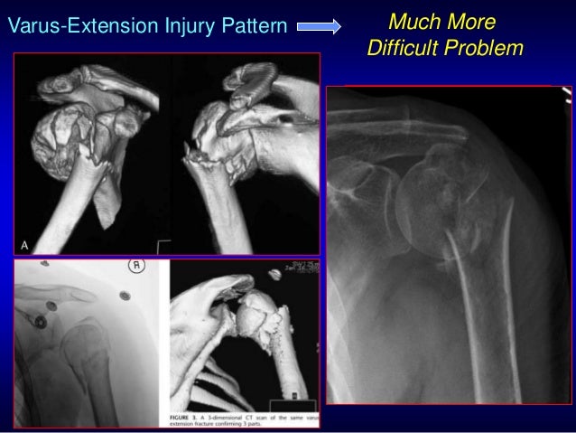 Varus Vs Valgus Fracture