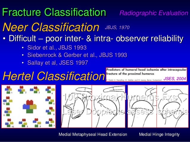 Current Concepts in Treatment of Proximal Humerus Fractures