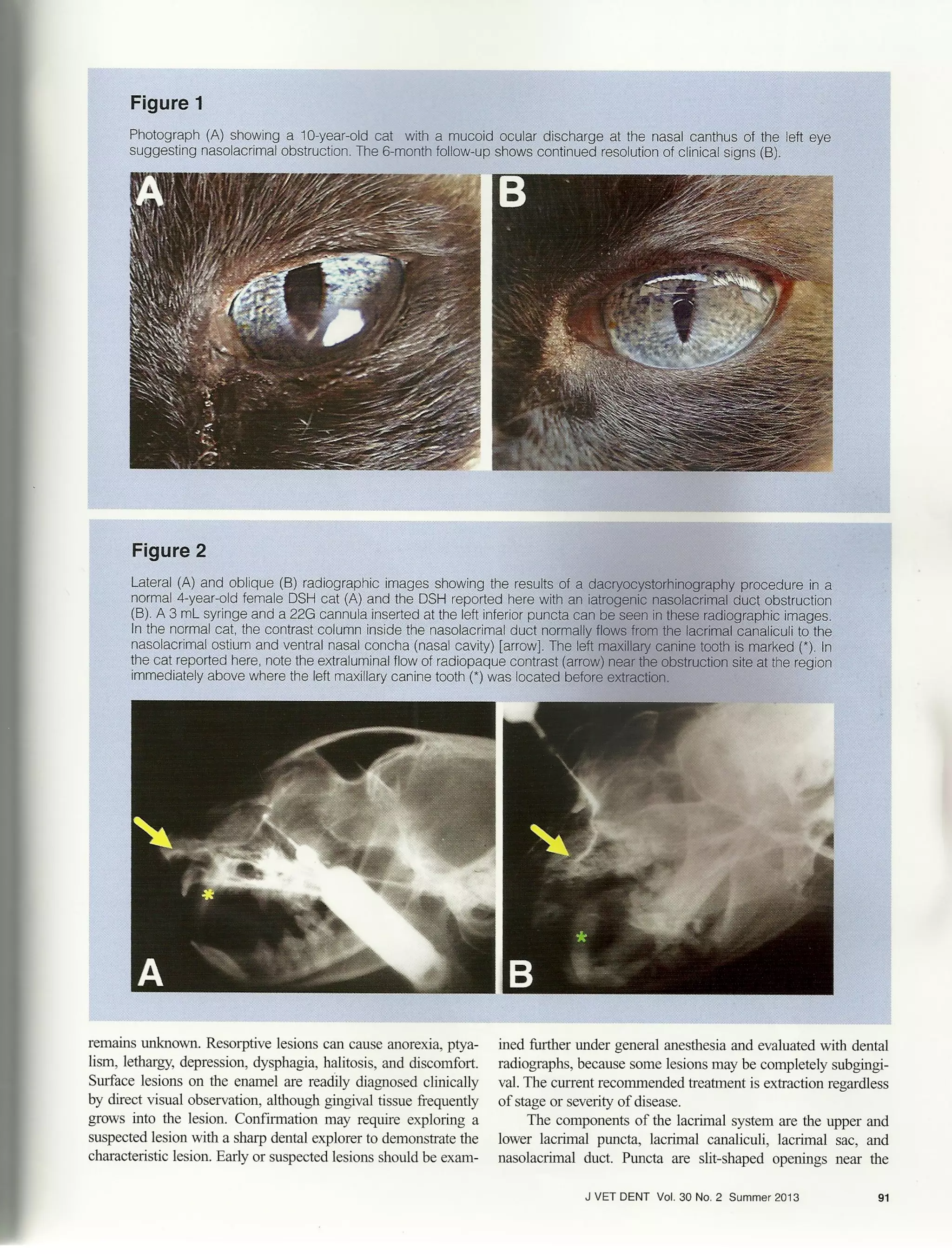 2013 iatrogenic nasolacrimal duct obstruction following tooth ...