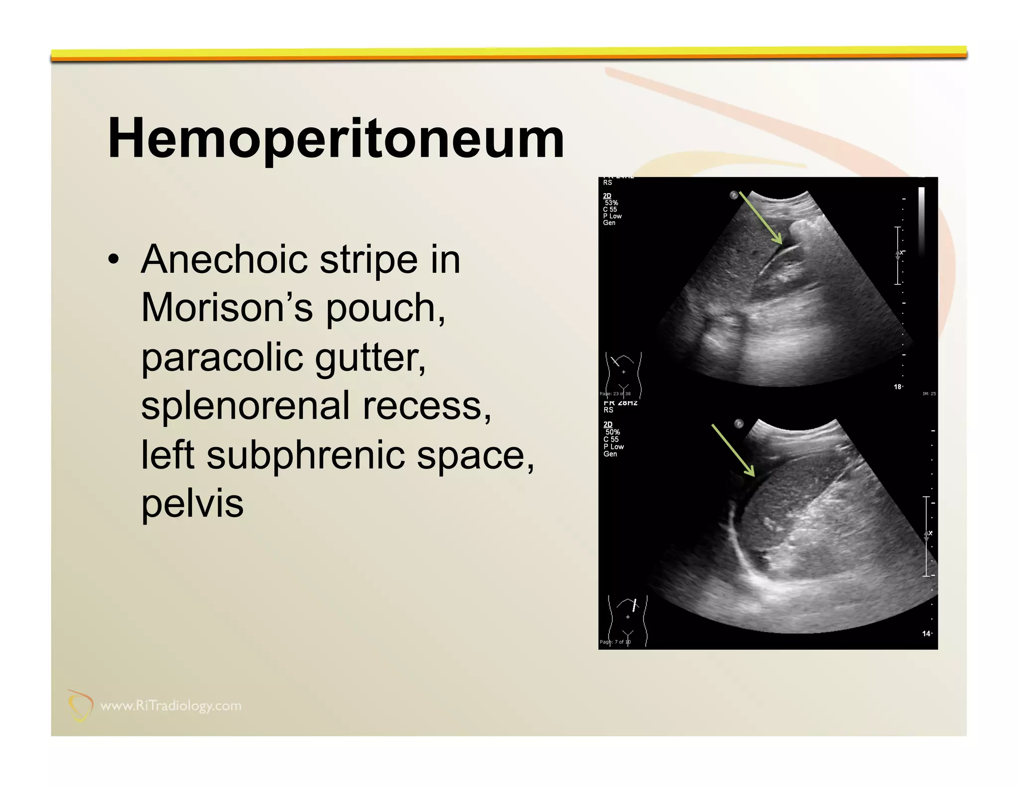 Imaging of Abdominal Trauma | PDF