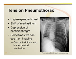 Imaging of Thoracic Trauma | PDF