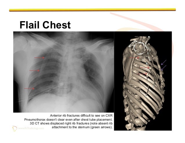 Imaging of Thoracic Trauma
