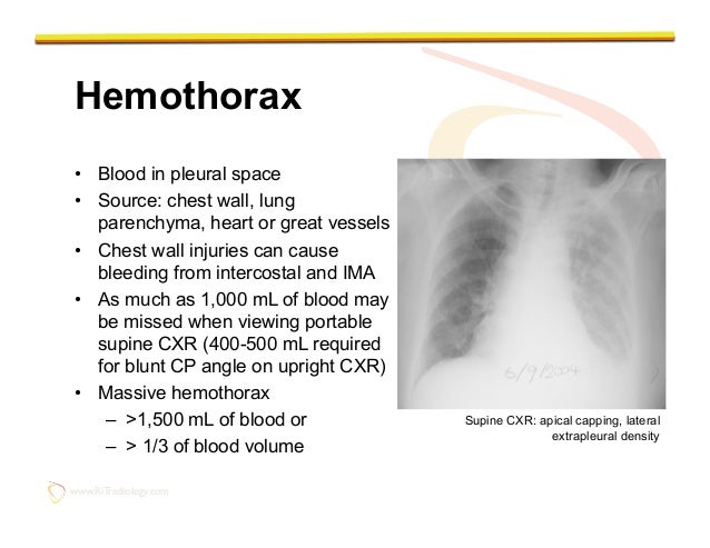 Imaging of Thoracic Trauma