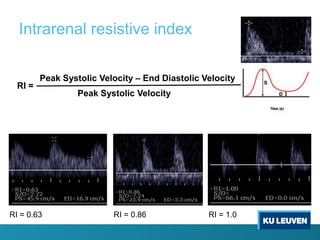 2014 01-24 eurotransplant meeting: resistive index after kidney ...
