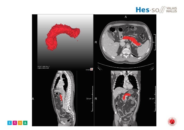Anatomical Correlations For A Hierarchical Multi Atlas Segmentation O
