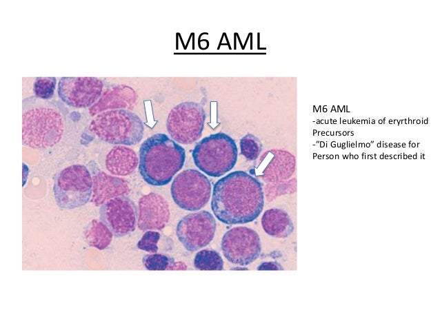 myeloid malignancy overview