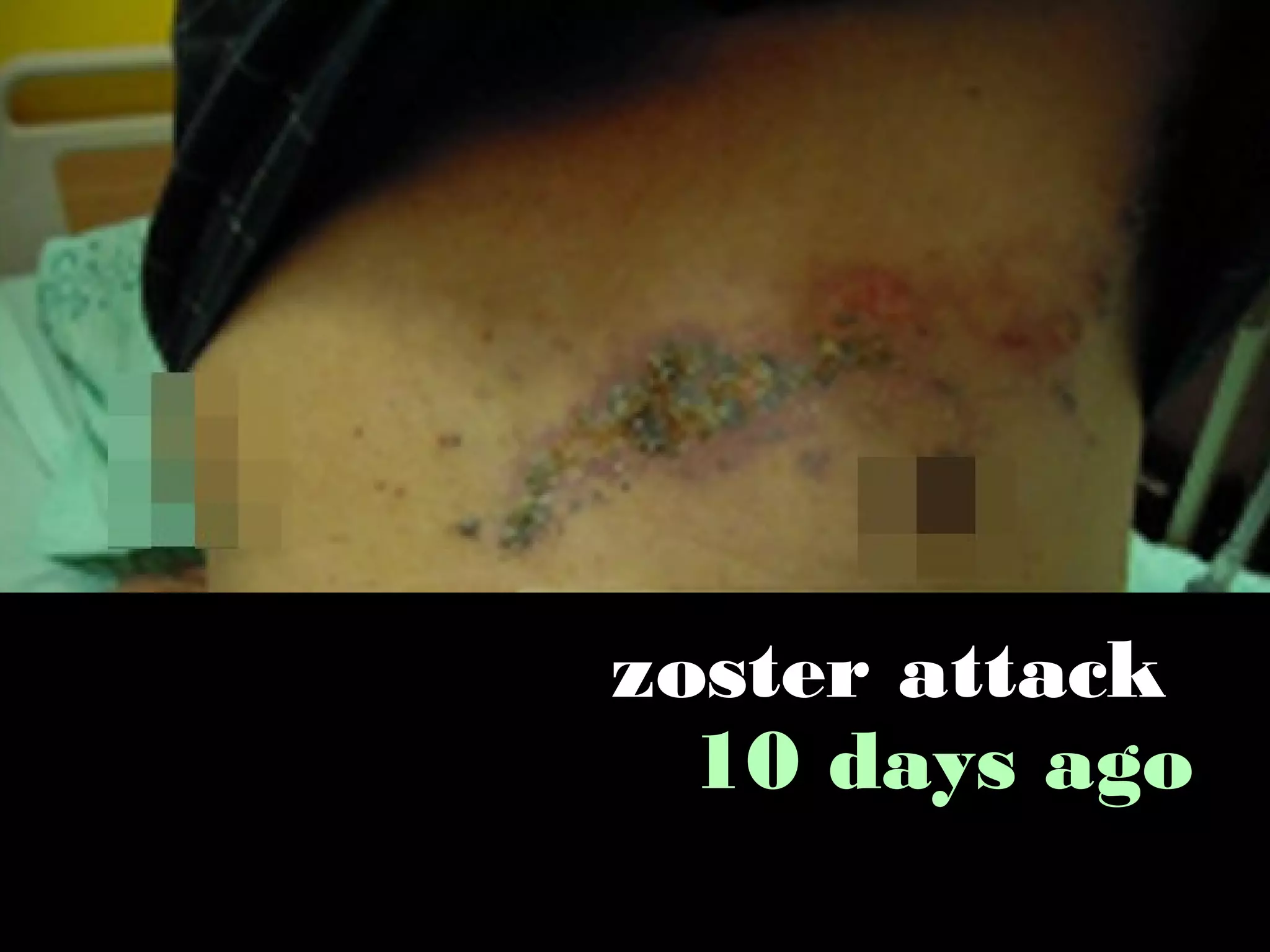 Herpes zoster infection in neurology: management updates and prevention ...