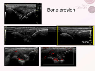 20140913 basic musculoskeletal ultrasound abnormalities kailen tsai更正版 ...