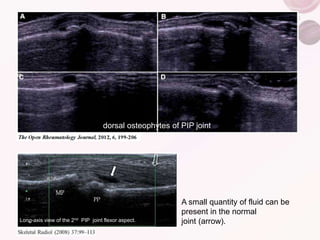 20140913 basic musculoskeletal ultrasound abnormalities kailen tsai更正版 ...