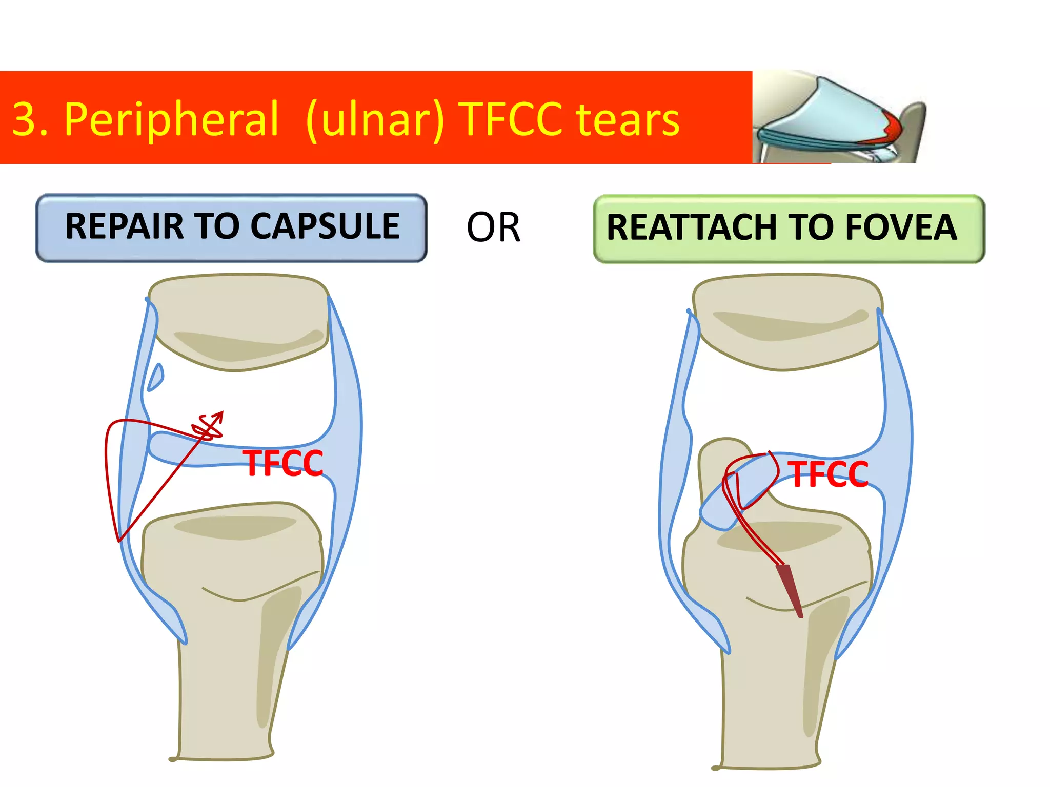 TFCC Repair in 2014: from hammoc to iceberg | PPT