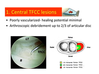 TFCC Repair in 2014: from hammoc to iceberg | PPT