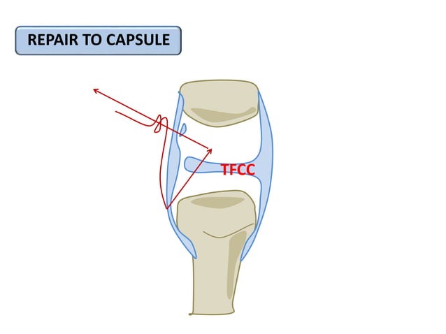 TFCC Repair in 2014: from hammoc to iceberg | PPT