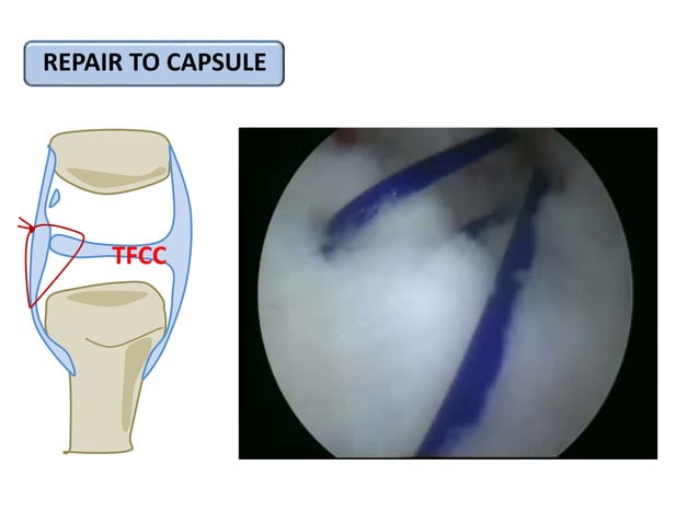 TFCC Repair in 2014: from hammoc to iceberg | PPT