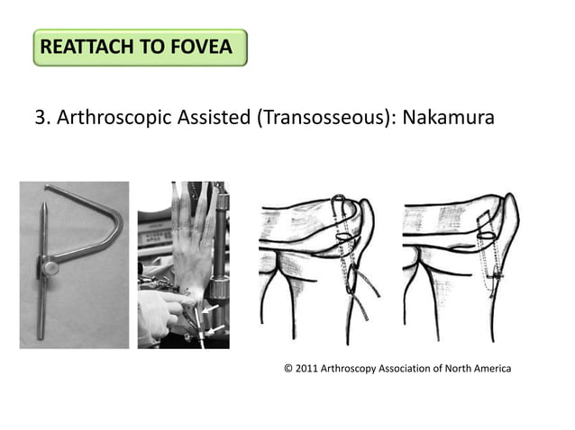 TFCC Repair in 2014: from hammoc to iceberg | PPT
