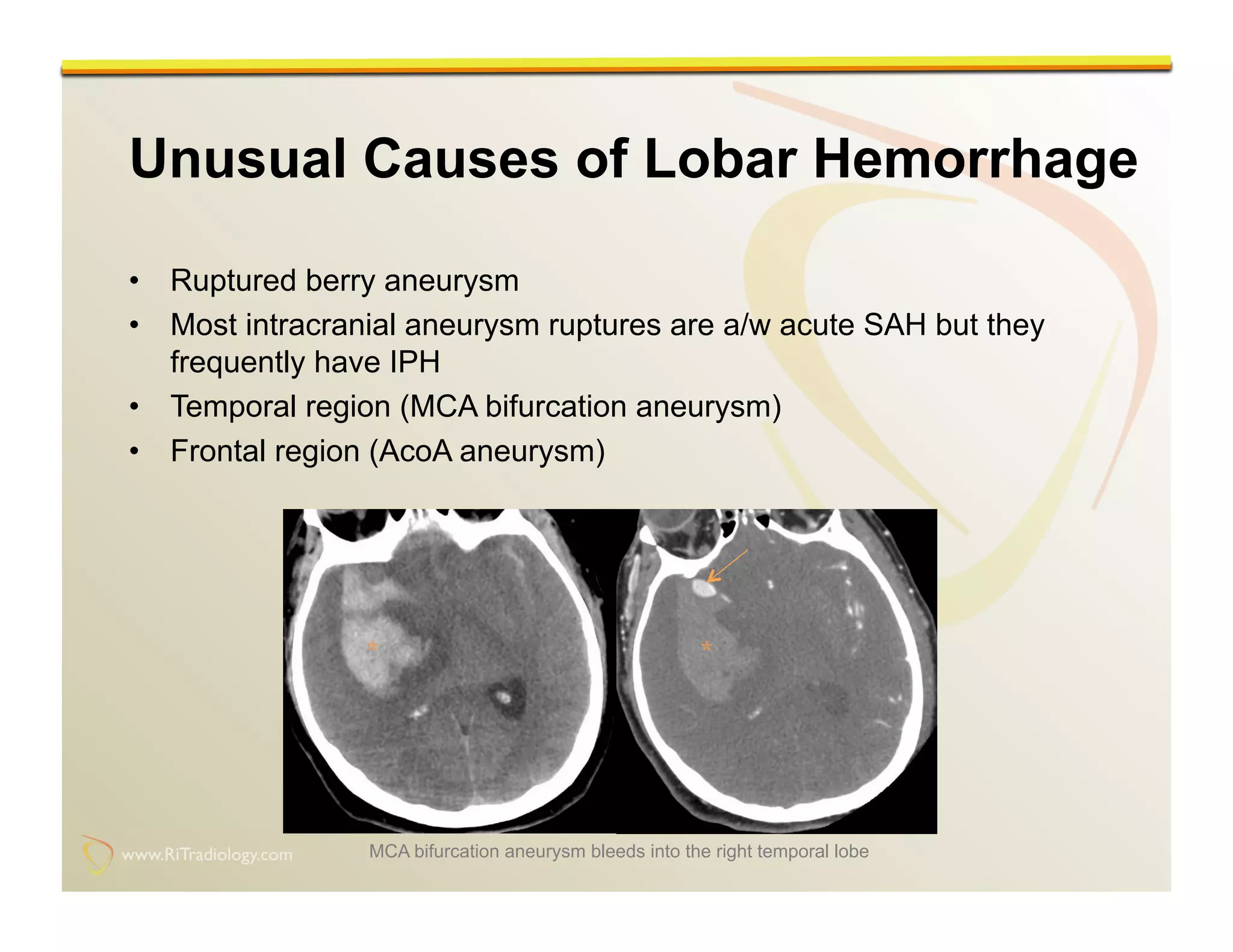 Imaging of Non-traumatic Intracranial Hemorrhage | PDF