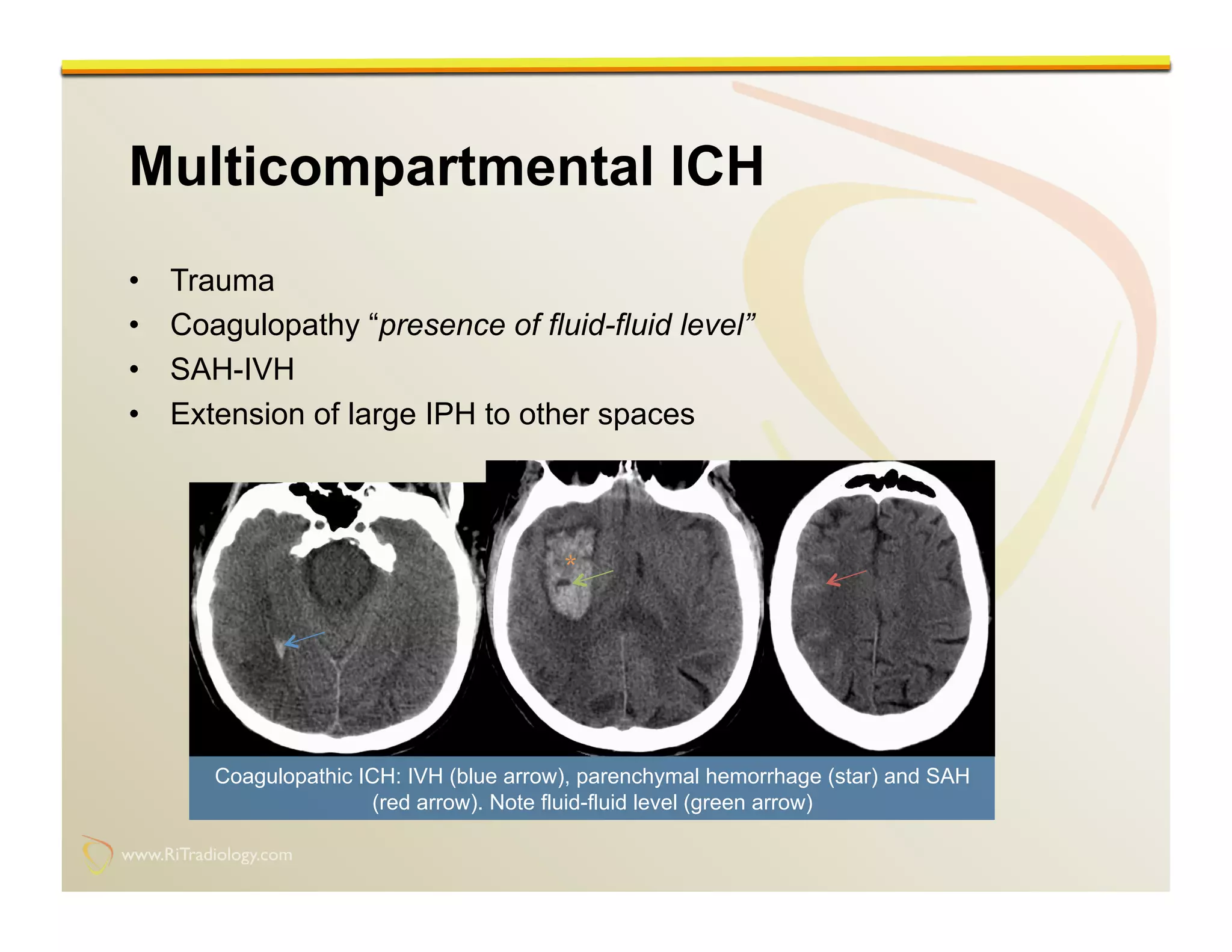 Imaging of Non-traumatic Intracranial Hemorrhage | PDF