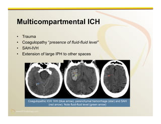 Imaging of Non-traumatic Intracranial Hemorrhage | PPT
